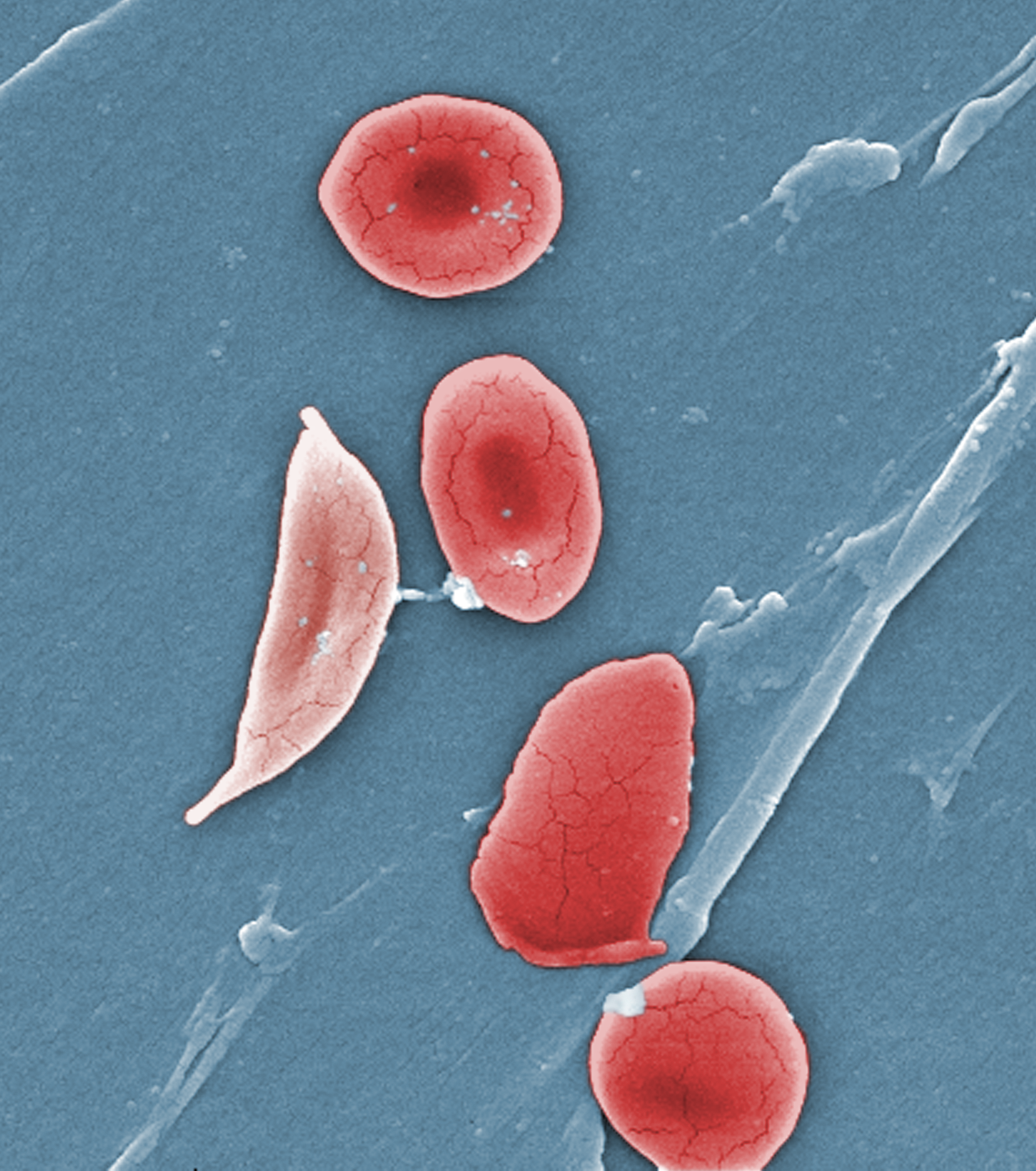 Slow Progress Towards Treatment Of Sickle Cell Anemia ScienceWriters Slow Progress Towards Treatment Of Sickle Cell Anemia ScienceWriters